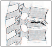 Figura10. Fracturacompleta «por estallido» del cuerpo vertebral