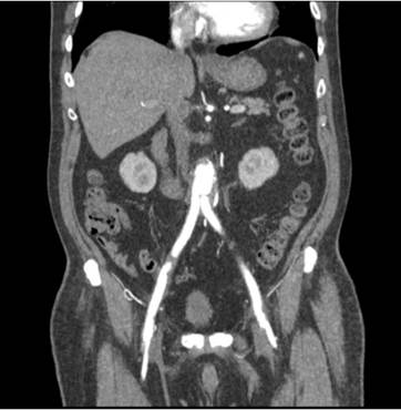 Figura1. TAC abdominal con contraste intravenoso. Prótesisaorto ...