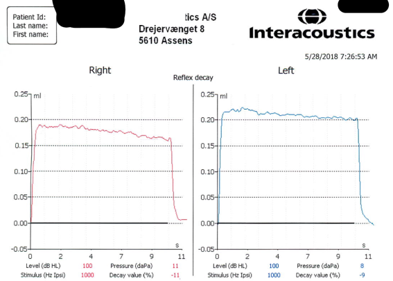 Table1. The mean (SD) of acoustic reflex (AR) decay and middle ear ...