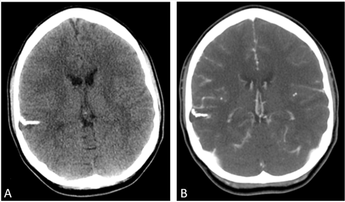 Figura 1. Imágenes de TCMD sincontraste (A) y con contraste intravenoso ...