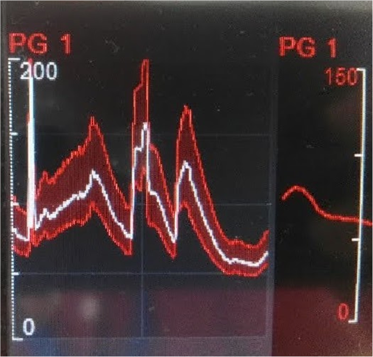 Figura3. Monitorización de la presión arterial invasiva: se ...