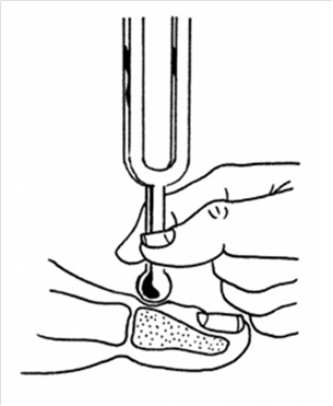 Figura 10. Método adecuado de usar undiapasón de 128 Hz para verificar ...